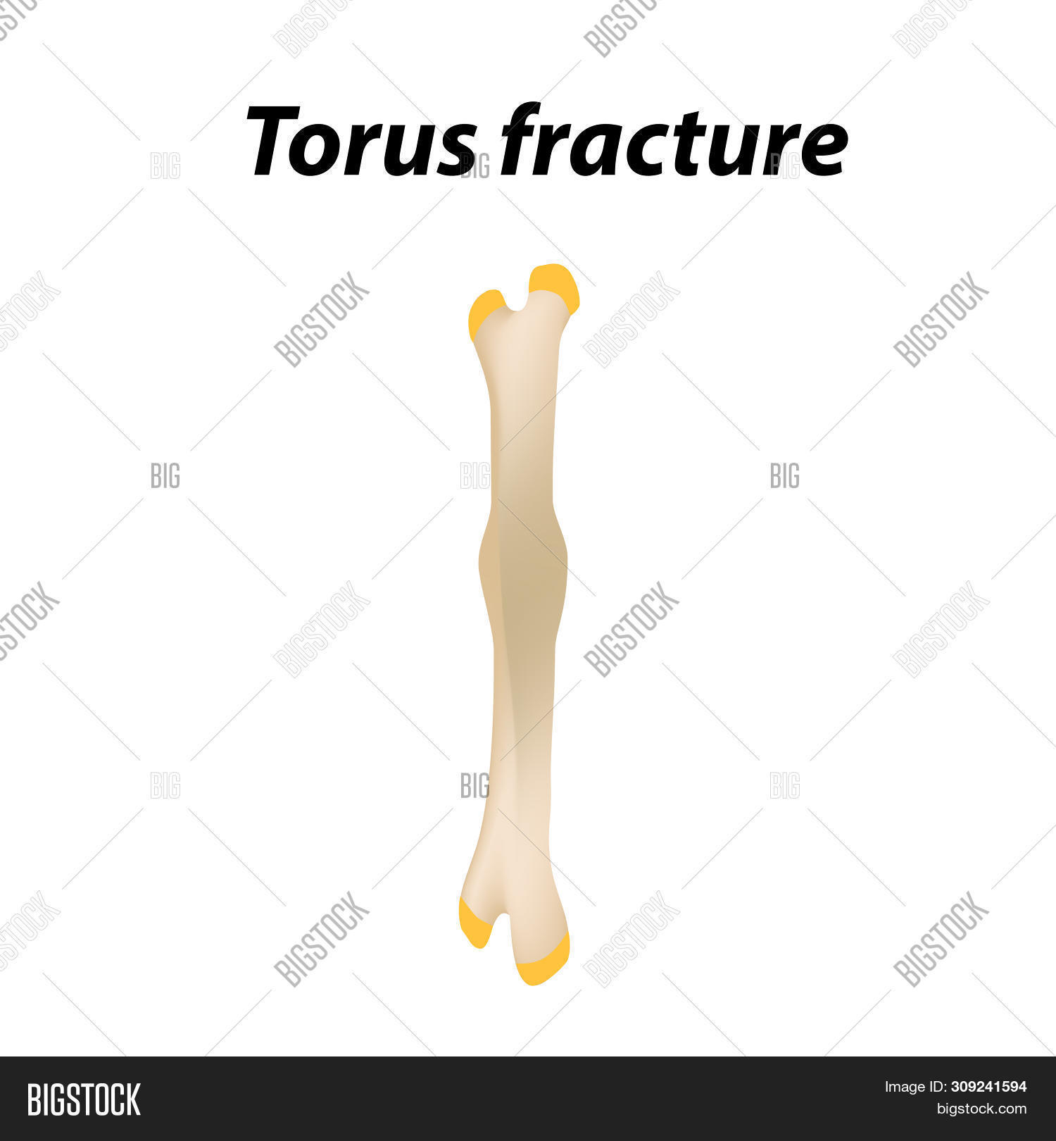Torus Fracture Bone. Image & Photo (Free Trial) | Bigstock