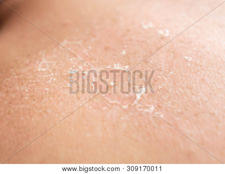 Flaking Skin After Image & Photo (Free Trial) | Bigstock