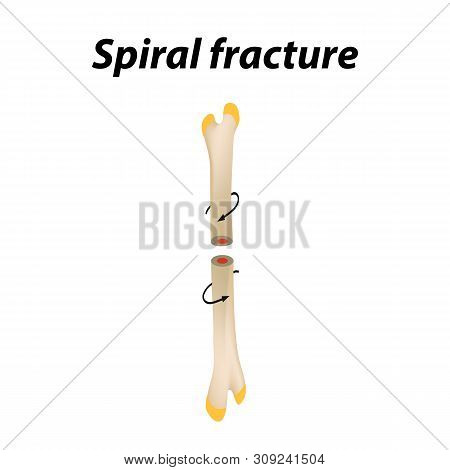 Spiral Bone Fracture. Image & Photo (Free Trial) | Bigstock