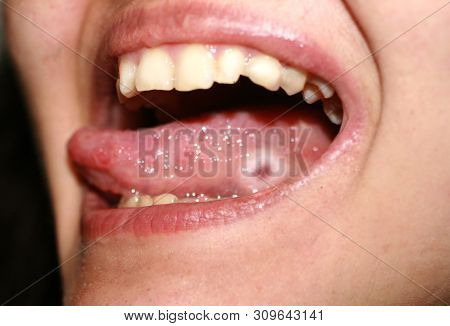 Amphotoid Stomatitis. Image & Photo (Free Trial) | Bigstock