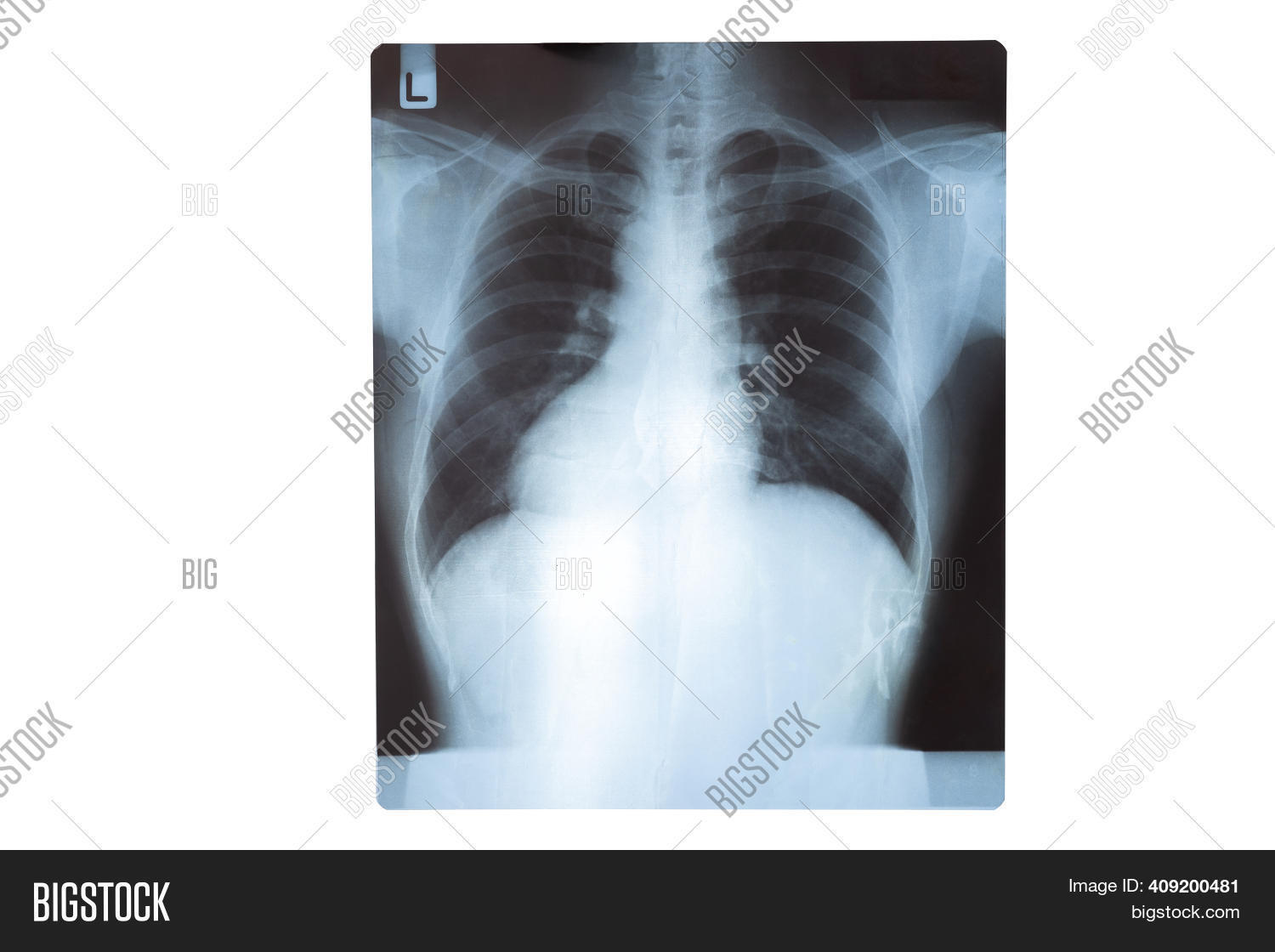 Chest X-ray Film Image & Photo (Free Trial) | Bigstock