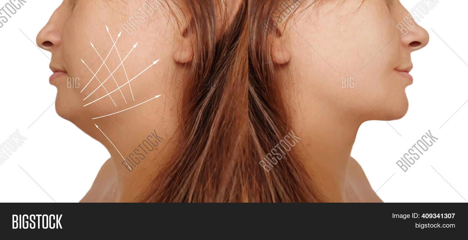 Woman Double Chin Image & Photo (Free Trial) | Bigstock