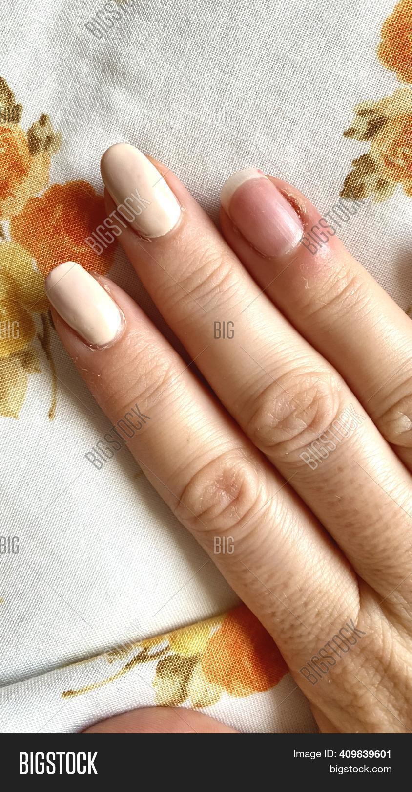 Paronychia, Swollen Image & Photo (Free Trial) | Bigstock