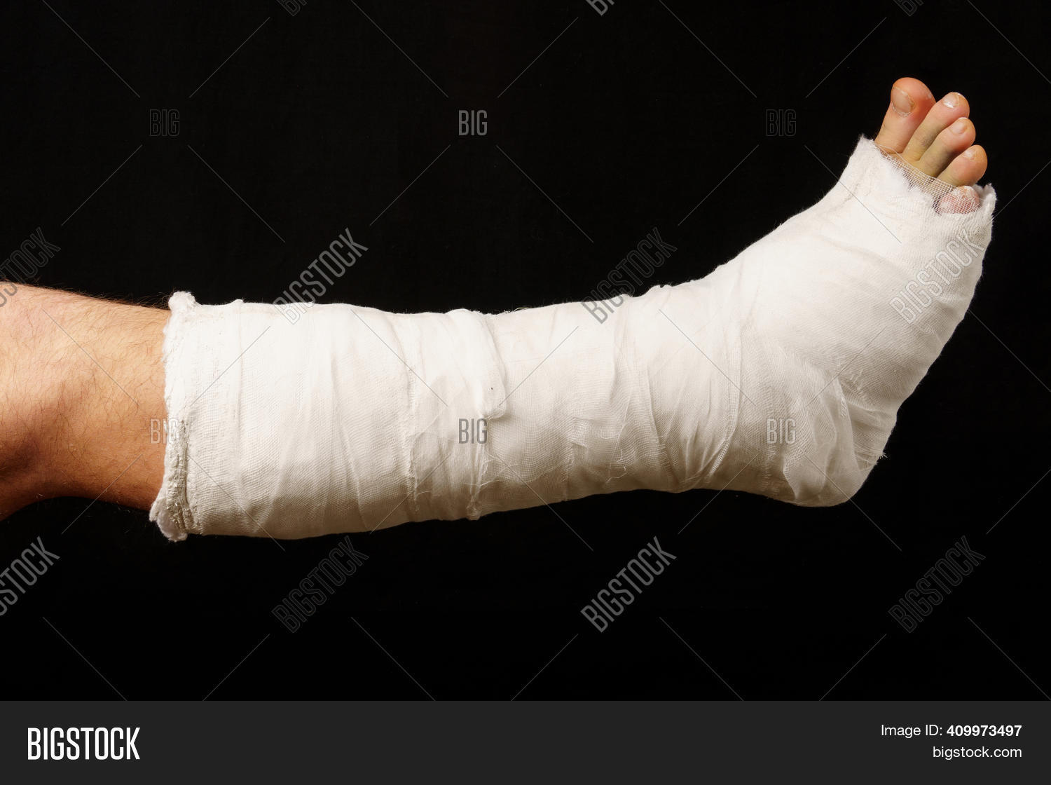Plaster Cast On Leg On Image & Photo (Free Trial) | Bigstock