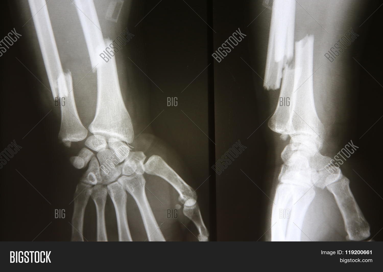 X-rays Images Bone Image & Photo (Free Trial) | Bigstock