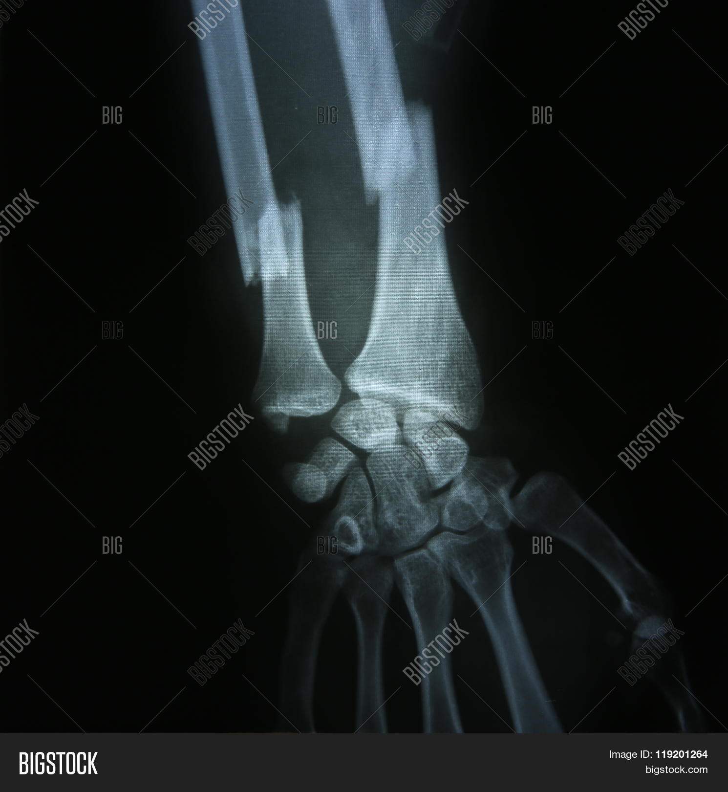 X-ray Photos Bone Image & Photo (Free Trial) | Bigstock