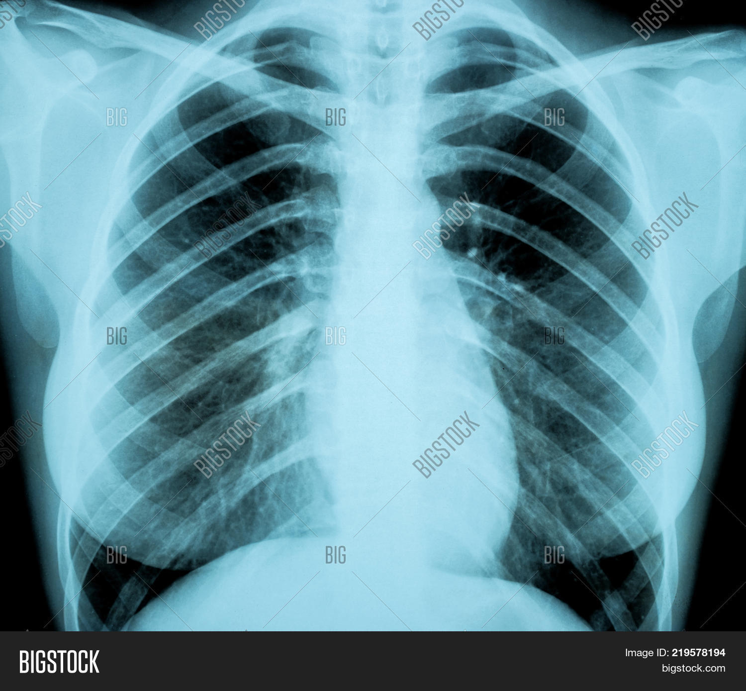 Chest Woman X-ray Image & Photo (Free Trial) | Bigstock