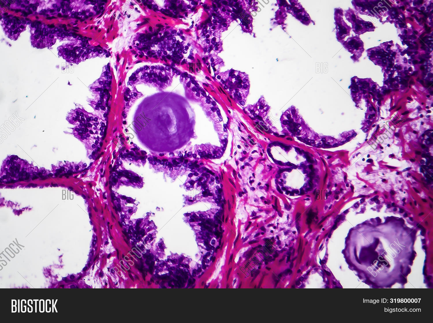 Benign Prostatic Image & Photo (Free Trial) | Bigstock