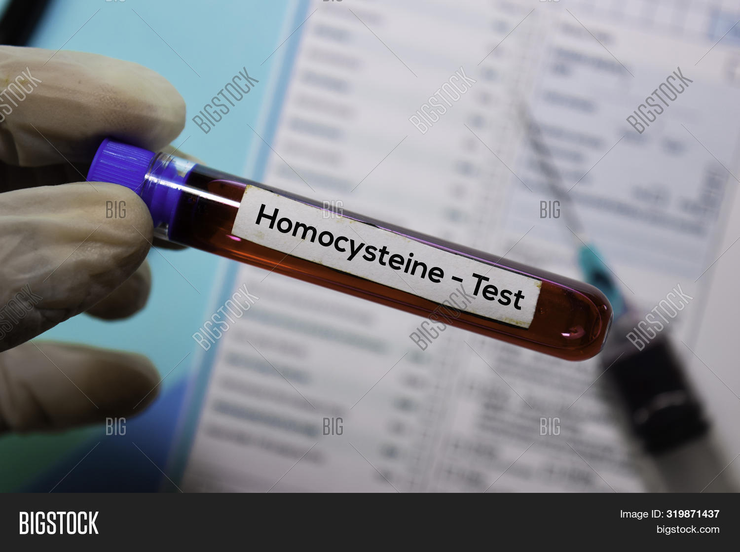 Blood Test Abbreviation For Homocysteine at Christopher Bryant blog
