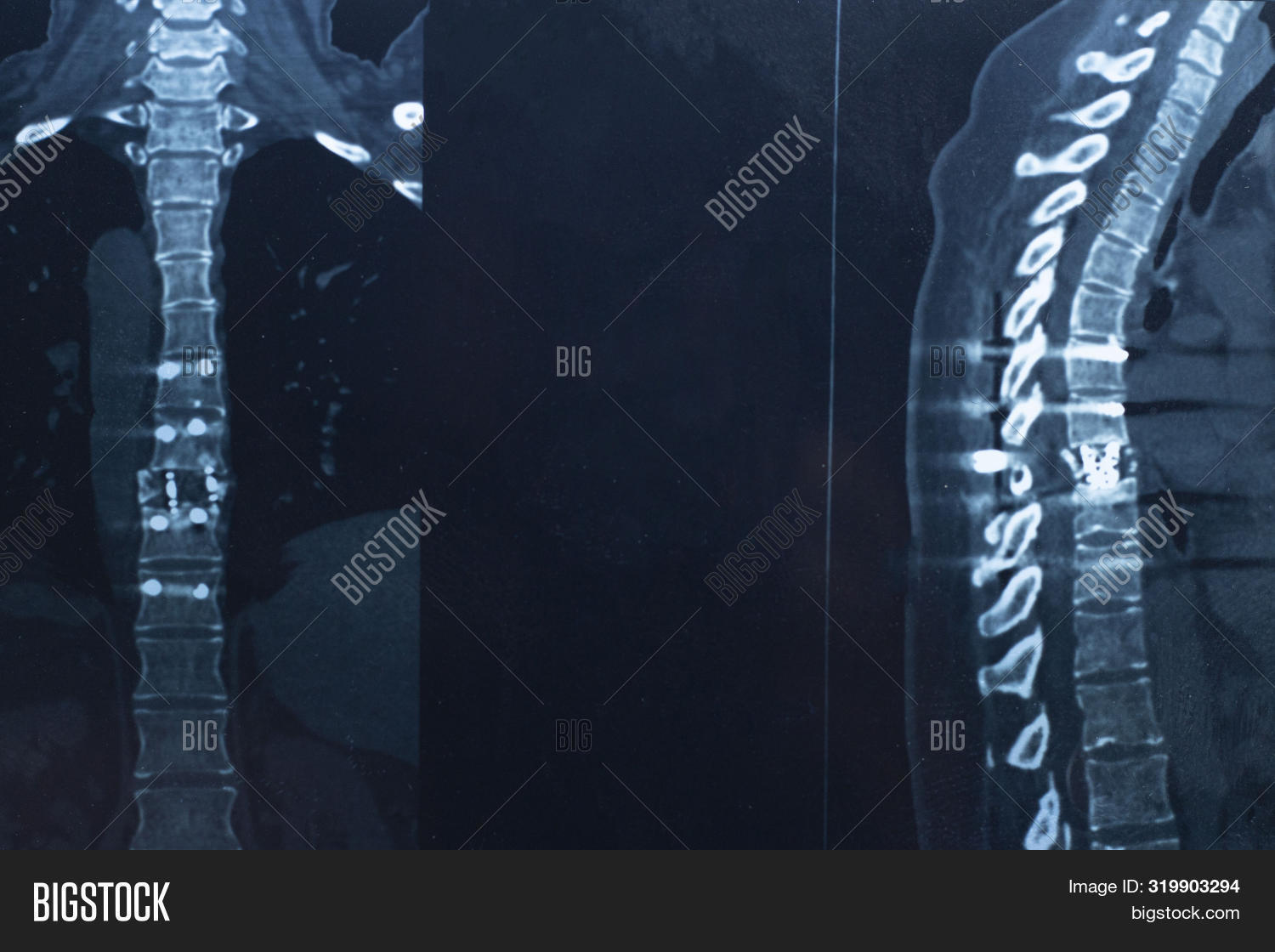 Spinal Fracture. Pins Image & Photo (Free Trial) | Bigstock