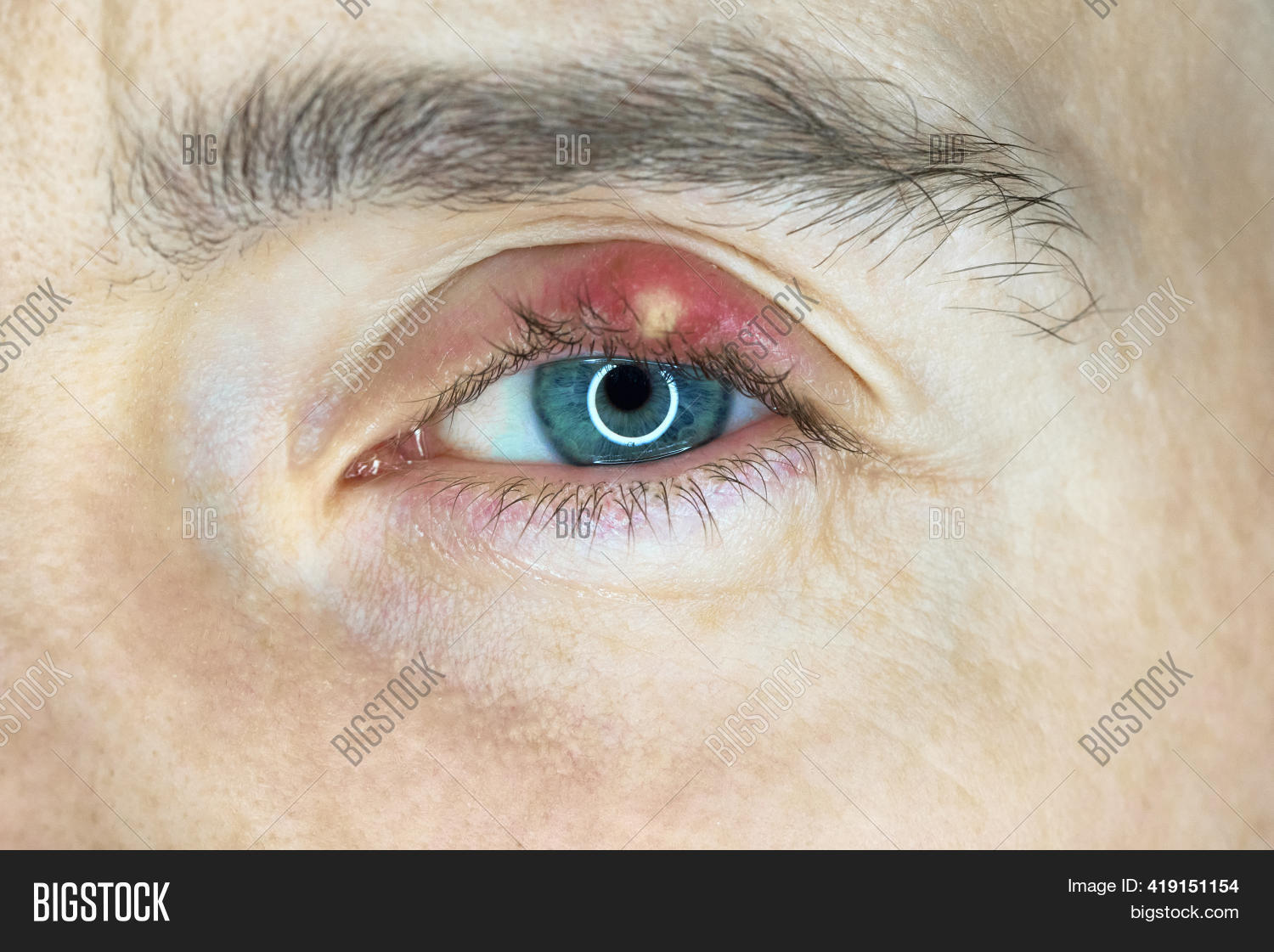 Chalazion On Eye. Image & Photo (Free Trial) | Bigstock