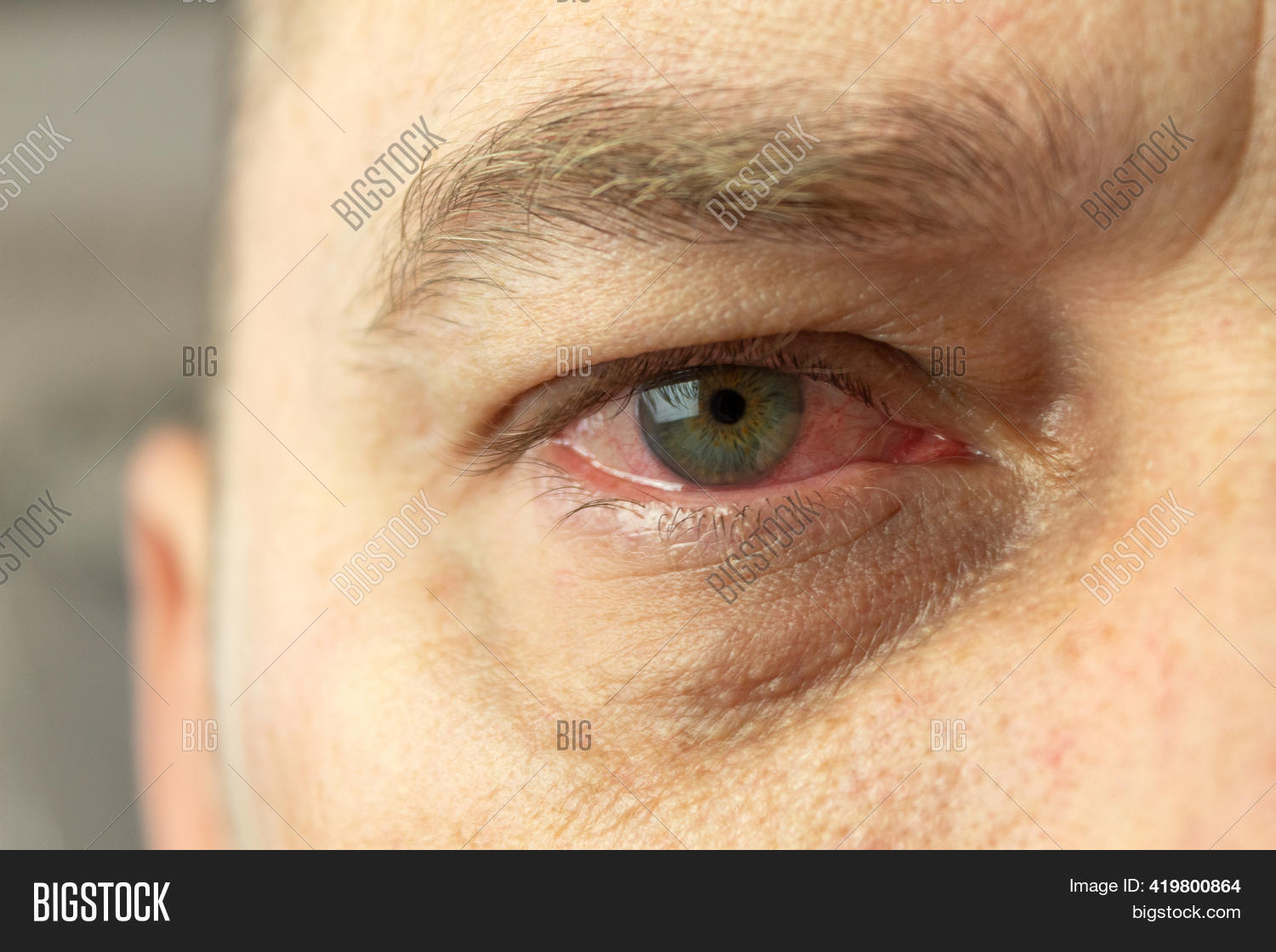 Red Inflamed Eye Close Image & Photo (Free Trial) | Bigstock