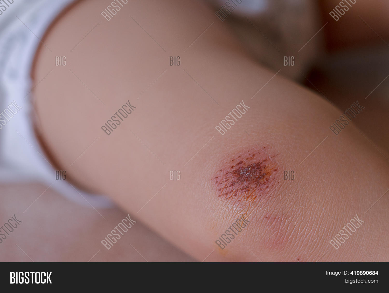 Close- Scabbed Scab On Image & Photo (Free Trial) | Bigstock