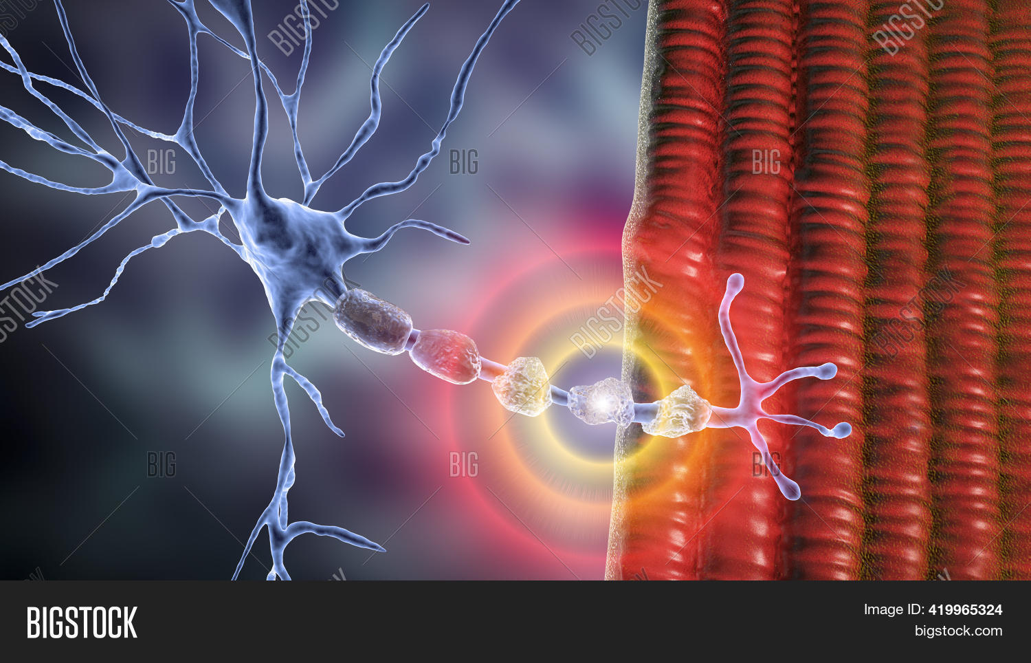 Demyelination Neuron, Image & Photo (Free Trial) | Bigstock
