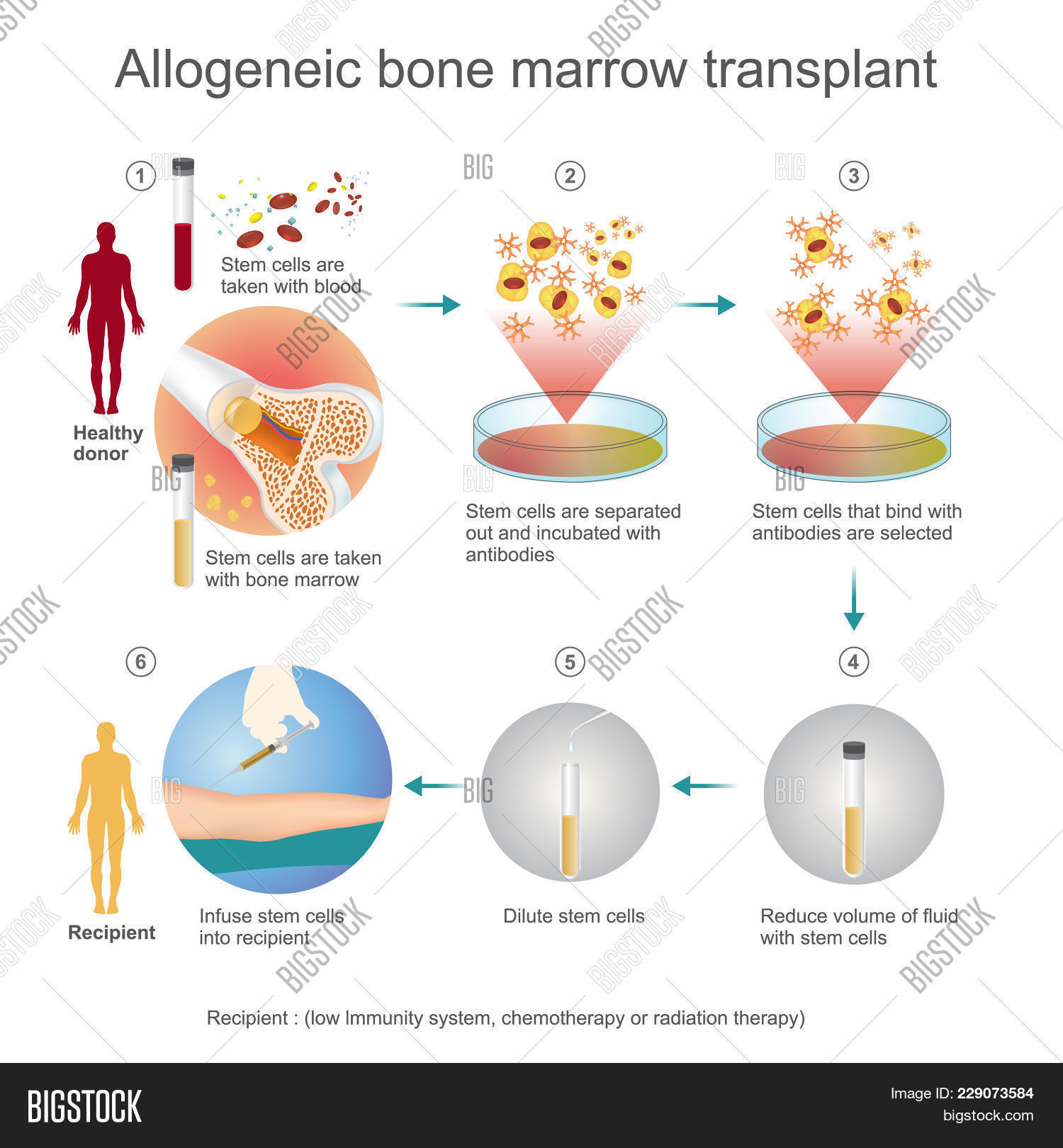 Allogeneic Transplant Image & Photo (Free Trial) | Bigstock