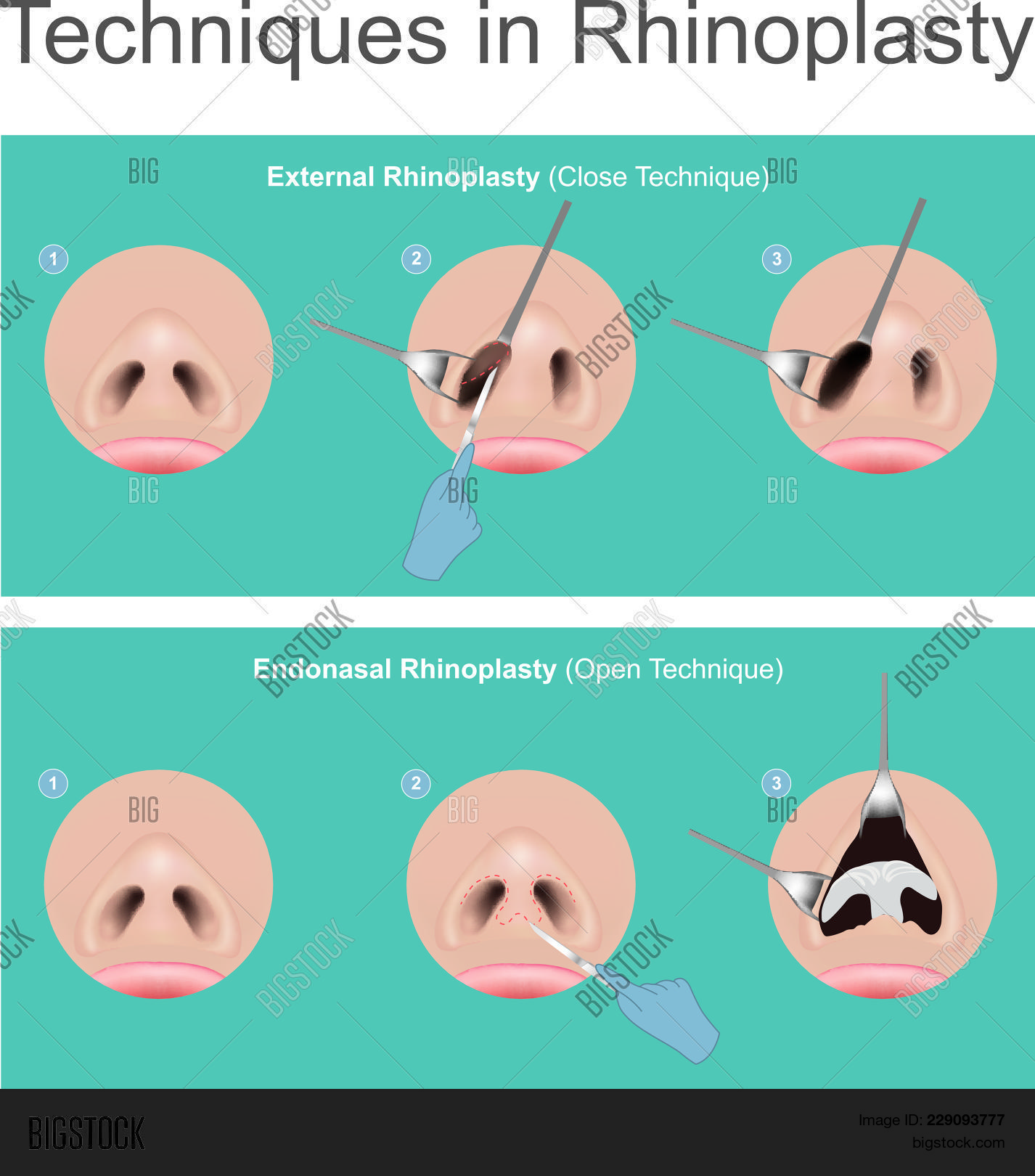 Nose Surgery Creates Vector & Photo (Free Trial) | Bigstock