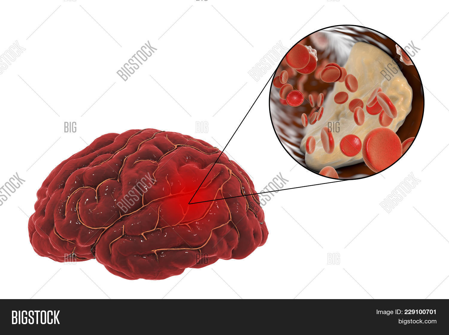 Ischemic Brain Stroke Image & Photo (Free Trial) | Bigstock