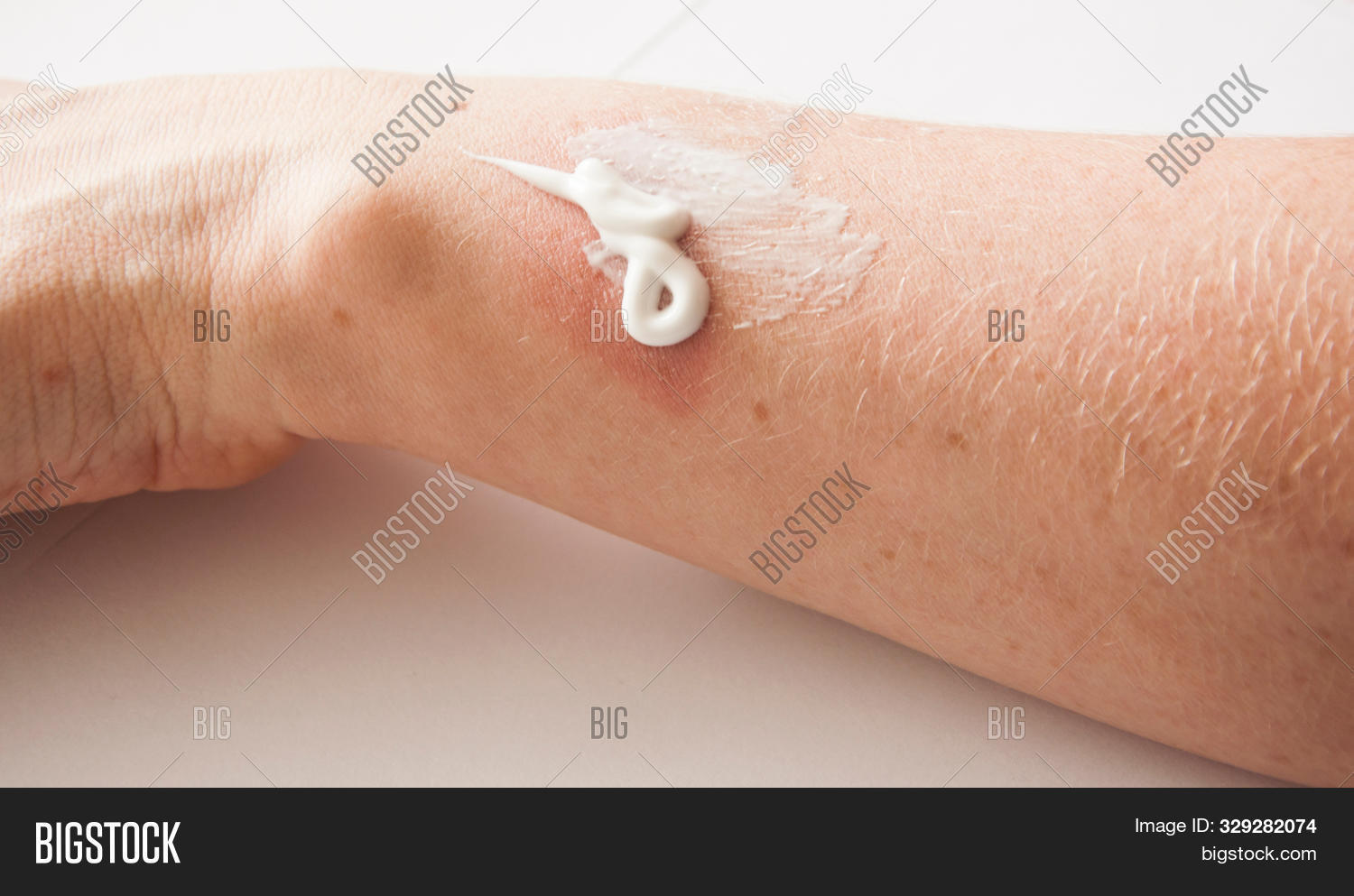 Woman Applying Scars Image & Photo (Free Trial) | Bigstock