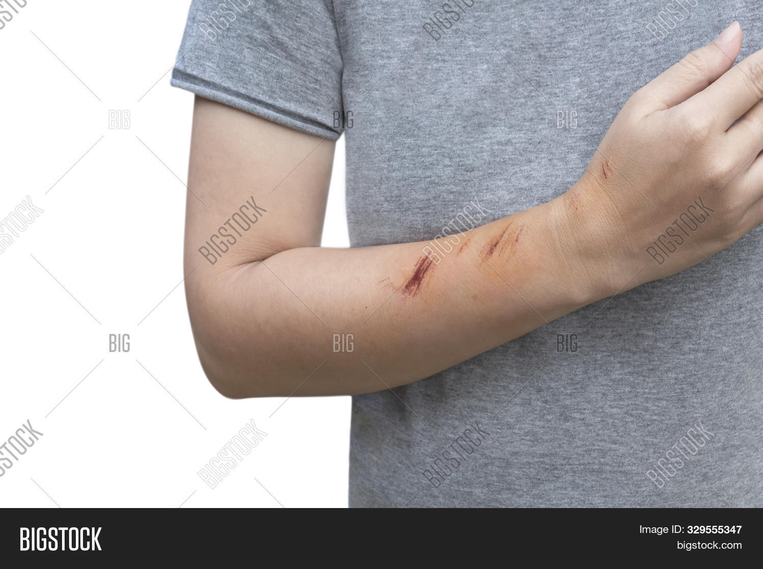 Wound Form Scabs On Image & Photo (Free Trial) | Bigstock