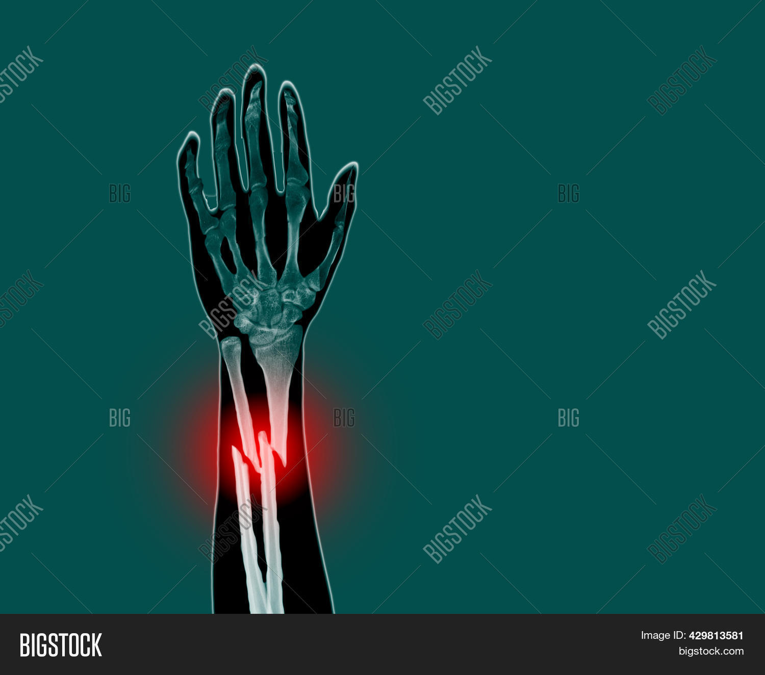 Film X-ray Forearm Image & Photo (Free Trial) | Bigstock