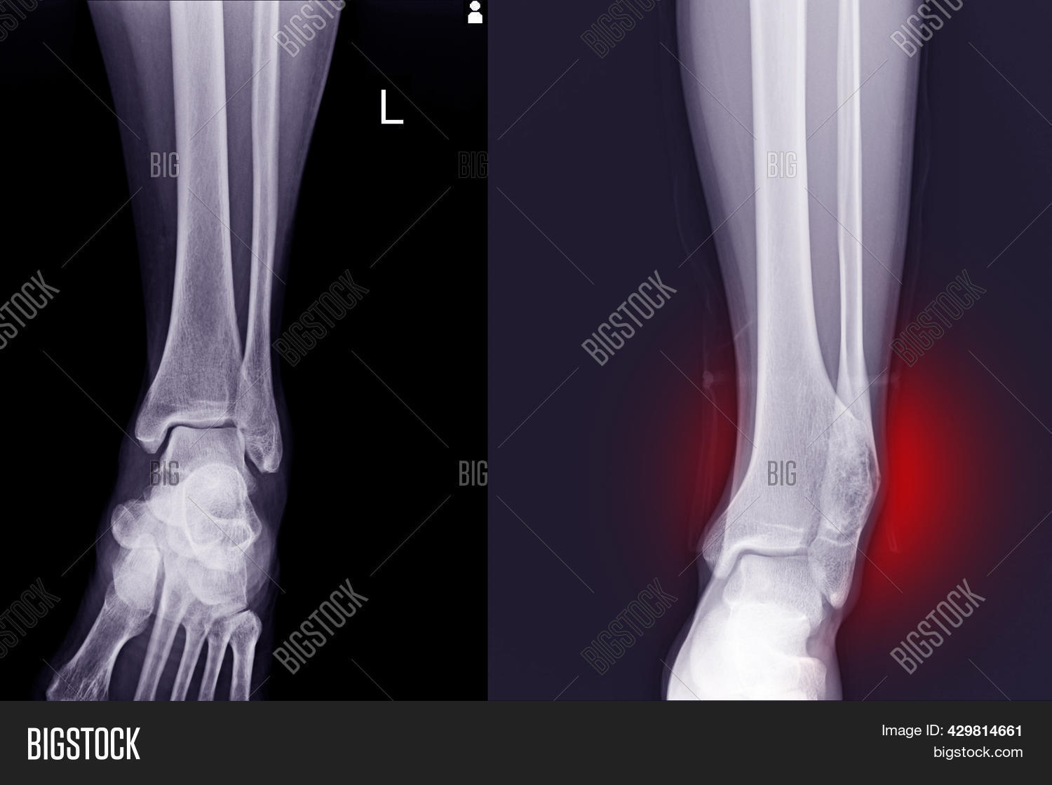 X-ray Foot Ankle Image & Photo (Free Trial) | Bigstock