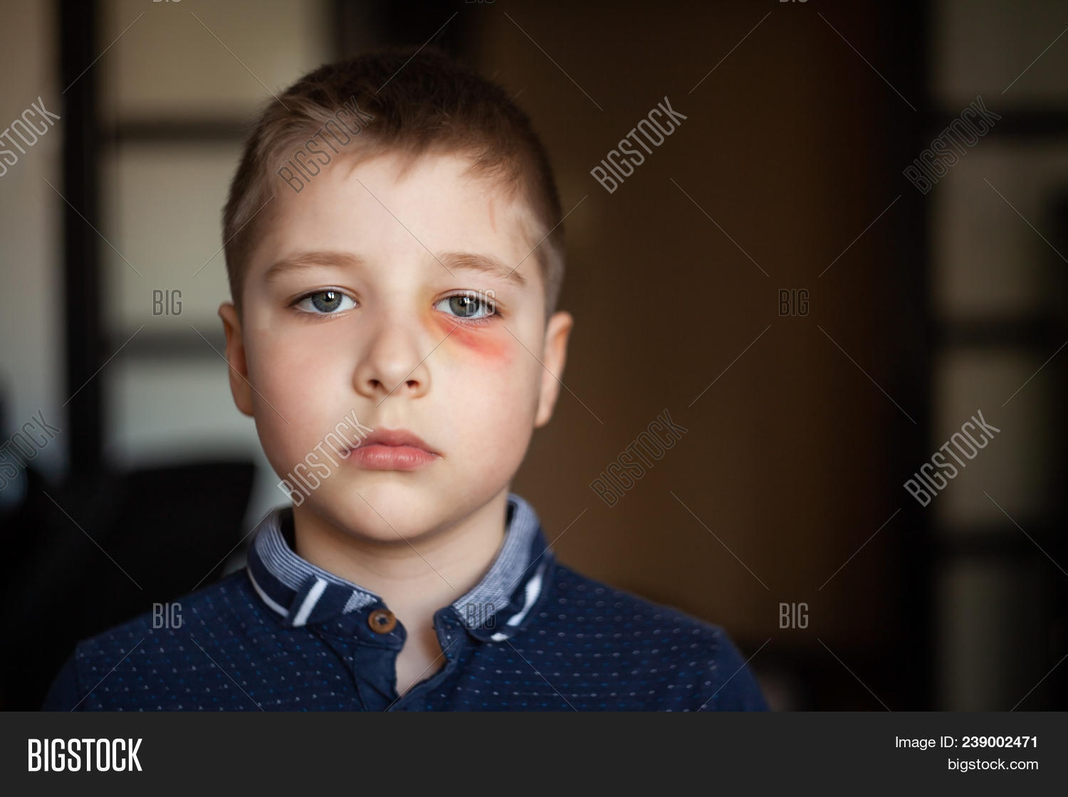 Boy Bruised Eye After Image & Photo (Free Trial) | Bigstock
