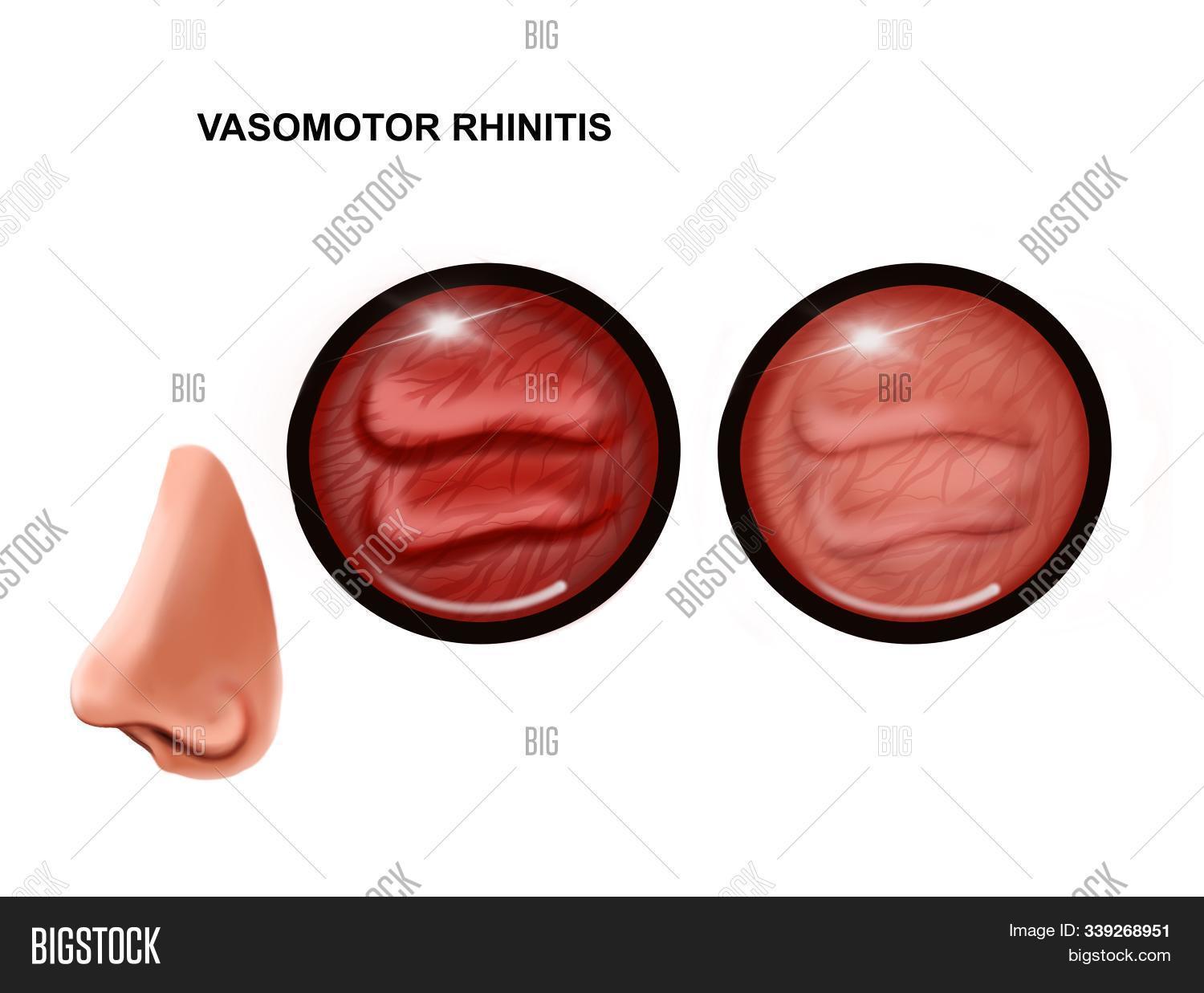 Illustration Vasomotor Image & Photo (Free Trial) | Bigstock