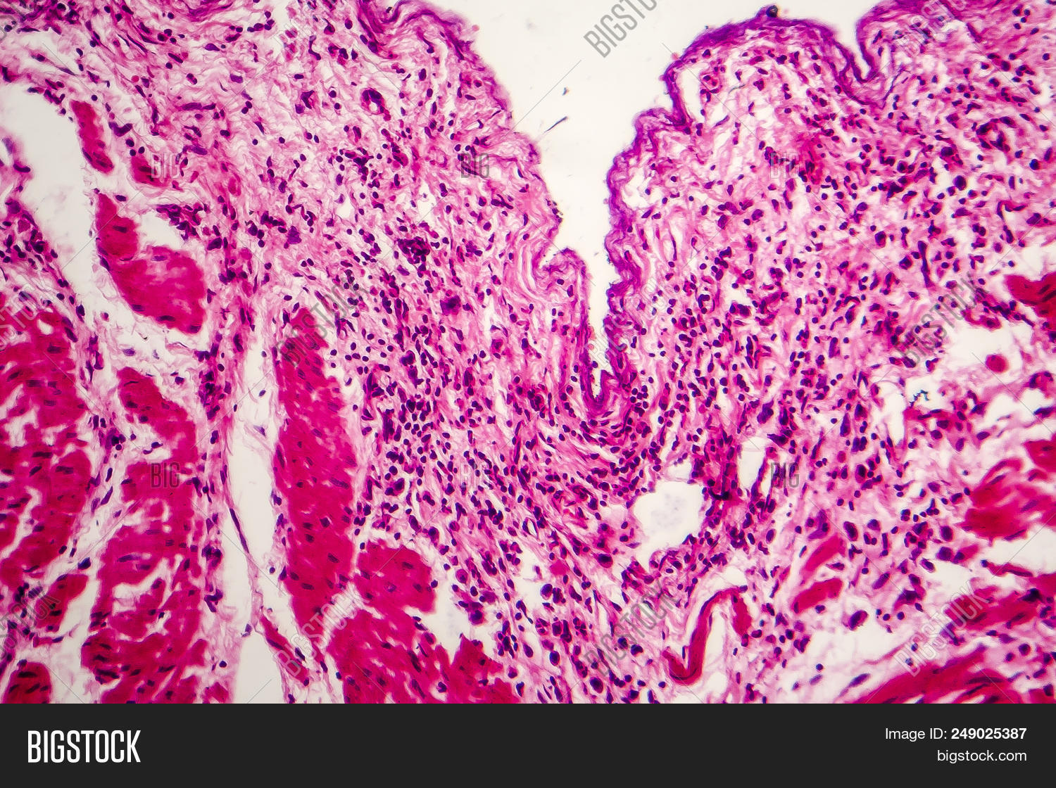 Signet Ring Cell Image & Photo (Free Trial) | Bigstock