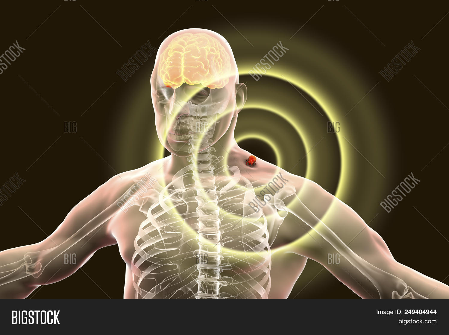 Tick-borne Image & Photo (Free Trial) | Bigstock