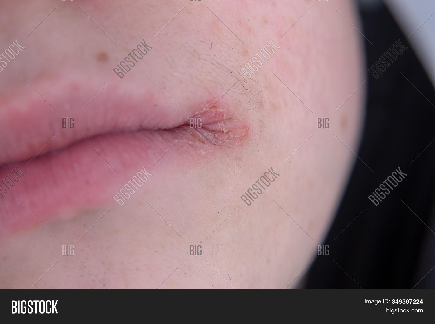 Atopic Dermatitis. Image & Photo (Free Trial) | Bigstock