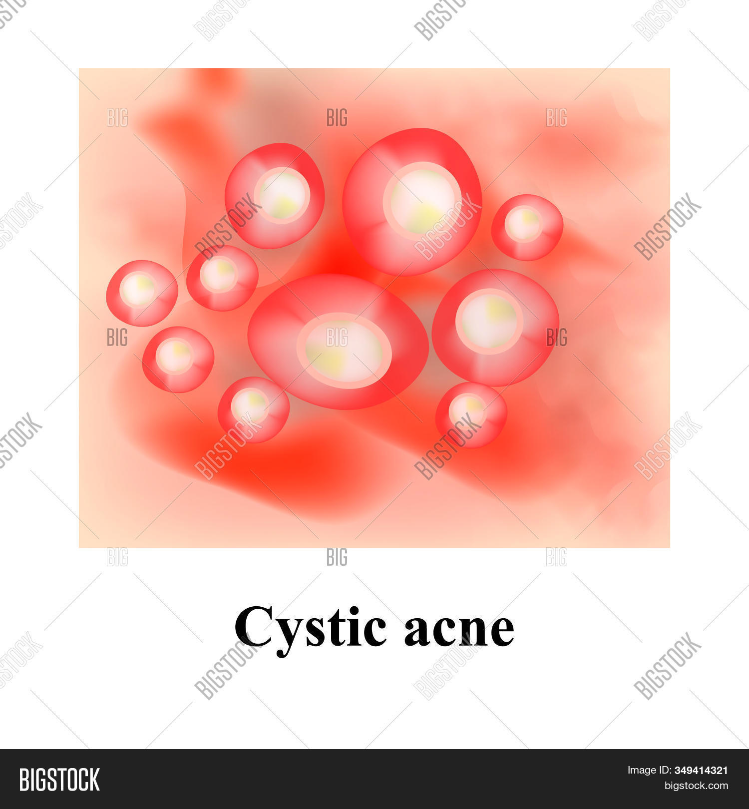 Pustules On Skin. Image & Photo (Free Trial) | Bigstock