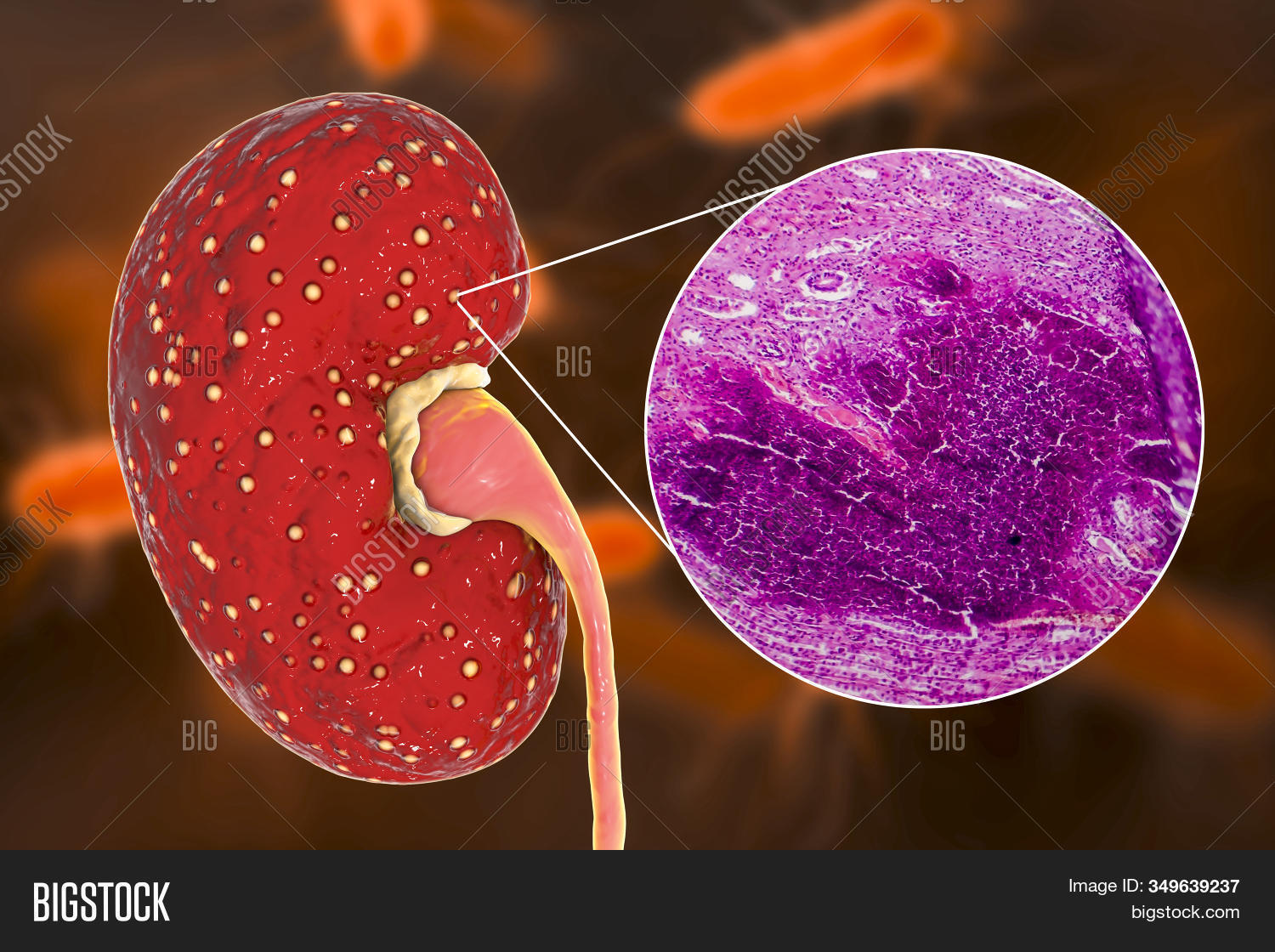 Acute Pyelonephritis, Image & Photo (Free Trial) | Bigstock