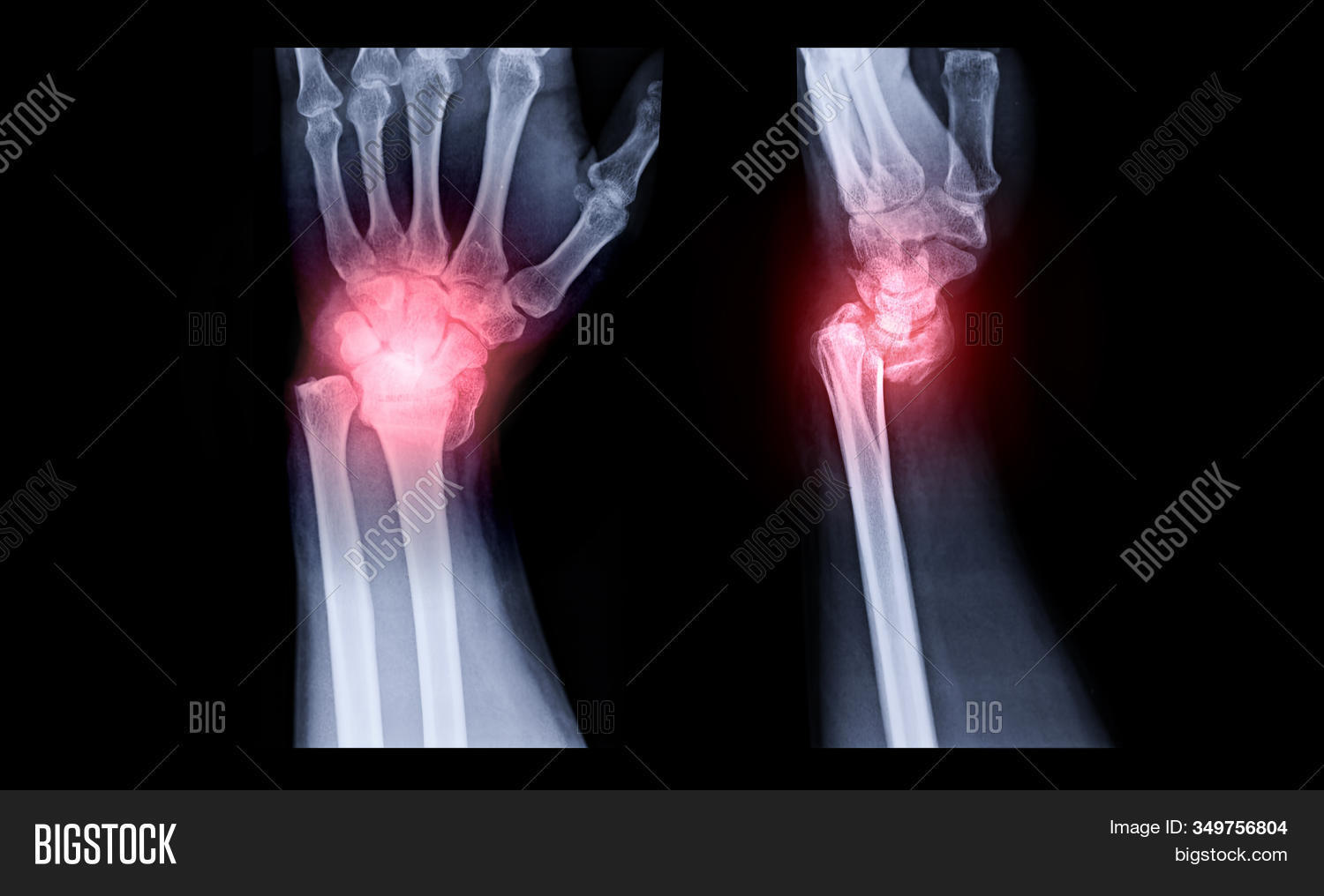 X-ray Image Left Wrist Image & Photo (Free Trial) | Bigstock