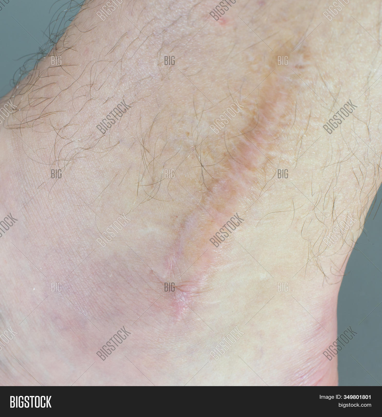 Old Healed Scar Image & Photo (Free Trial) | Bigstock