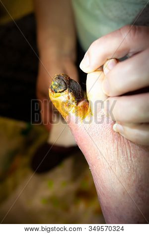 Gangrene Toe Old Image & Photo (Free Trial) | Bigstock