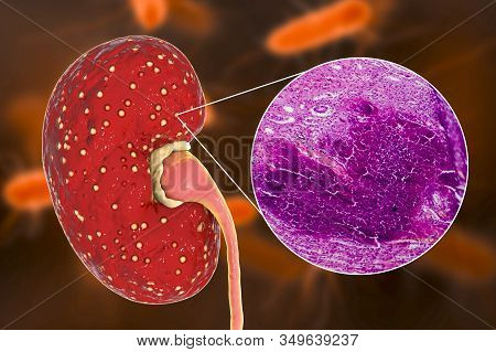 Acute Pyelonephritis, Image & Photo (Free Trial) | Bigstock