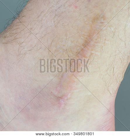 Old Healed Scar Image & Photo (Free Trial) | Bigstock