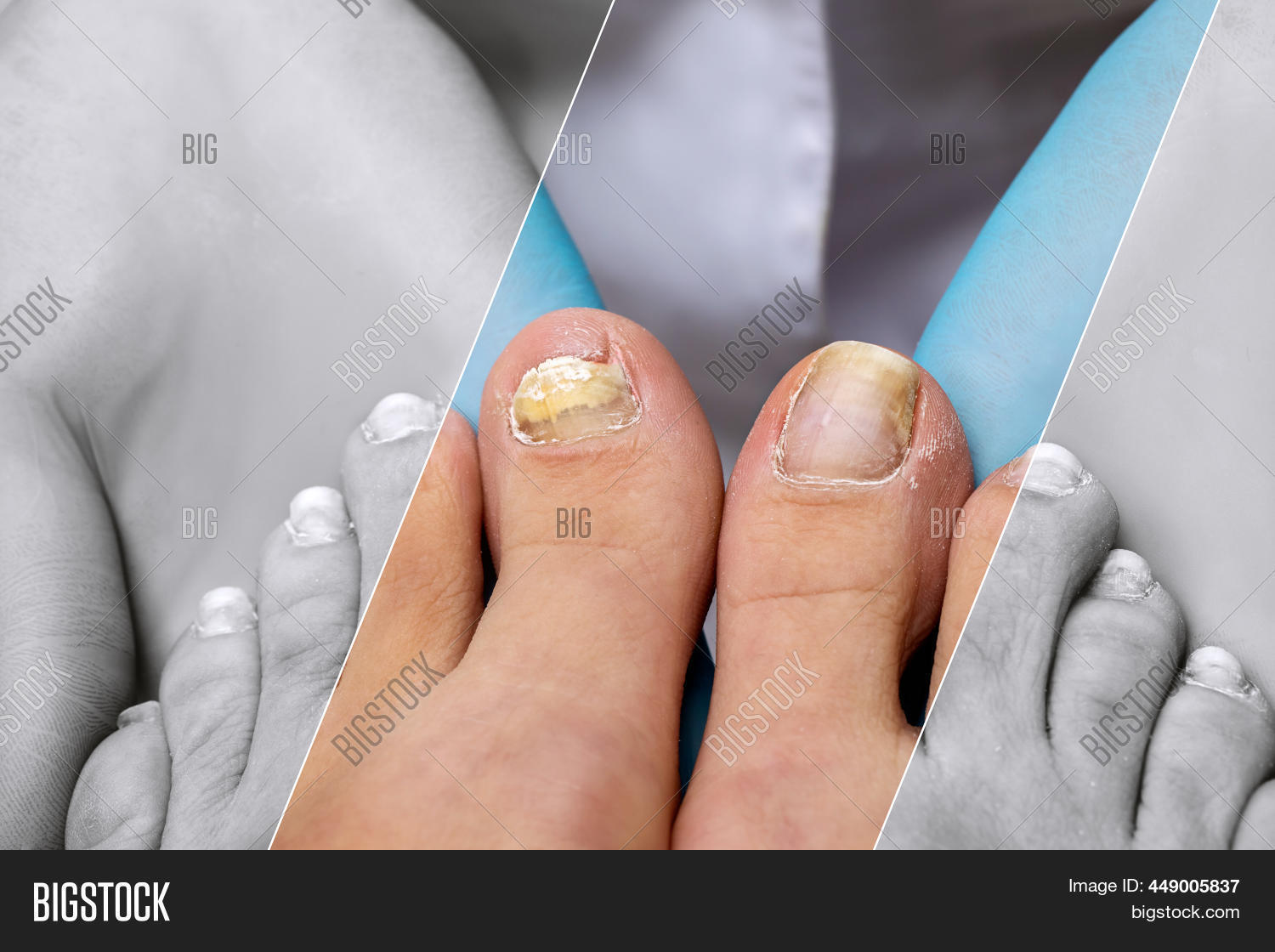 Onycholysis Toenails Image & Photo (Free Trial) | Bigstock