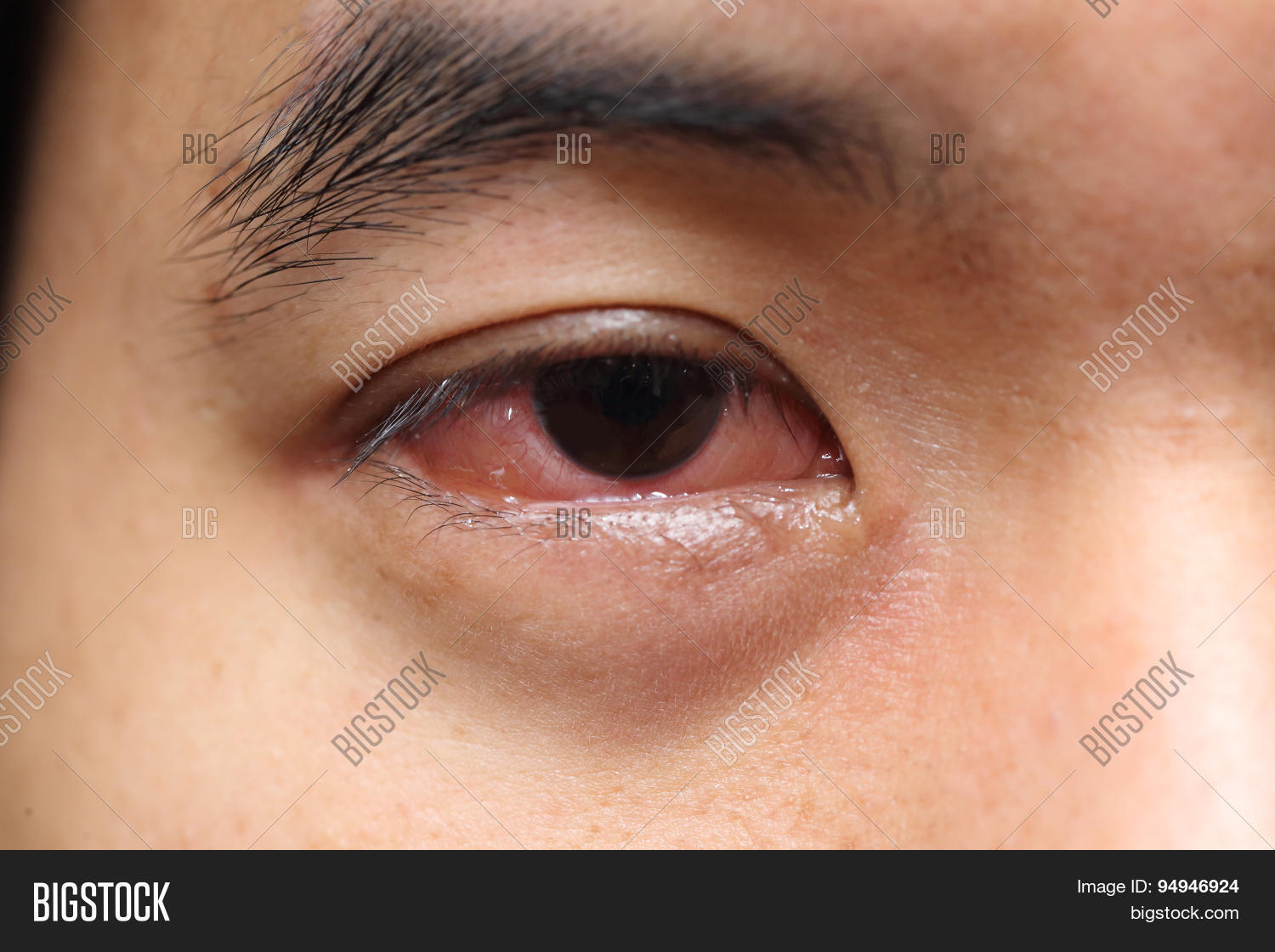 Red Sore Allergy Eye Image & Photo (Free Trial) | Bigstock