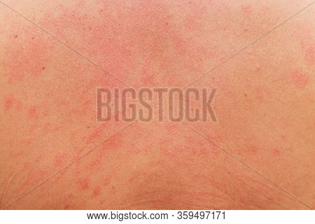 Allergic Rash On Body Image & Photo (Free Trial) | Bigstock
