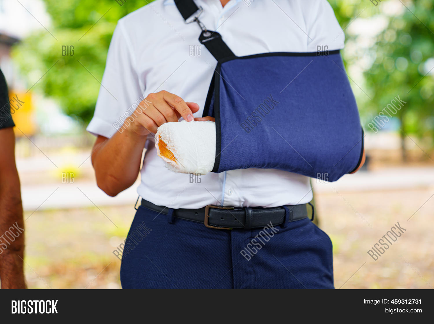 Man Broken Arm Cast. Image & Photo (Free Trial) | Bigstock