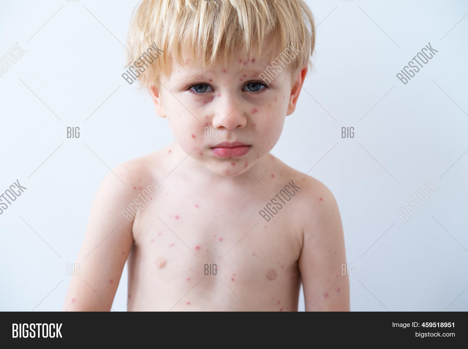 Chickenpox Disease, Image & Photo (Free Trial) | Bigstock