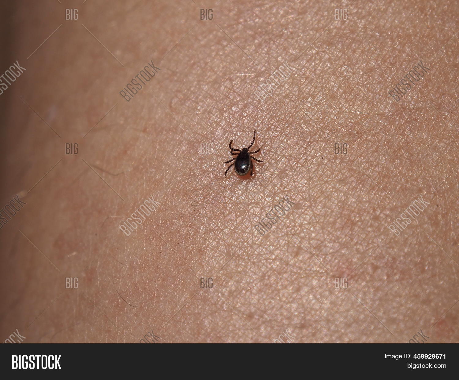 Tick On Human Body. Image & Photo (Free Trial) | Bigstock