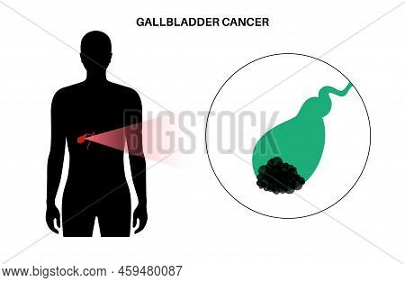 Gallbladder Cancer Vector & Photo (Free Trial) | Bigstock