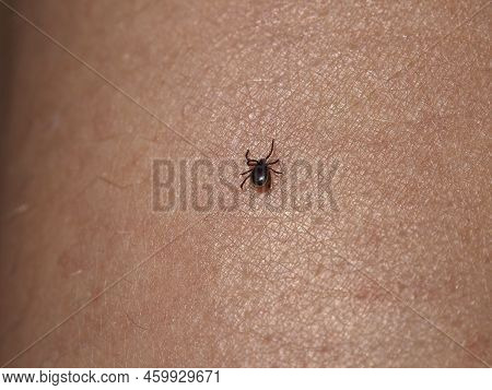 Tick On Human Body. Image & Photo (Free Trial) | Bigstock