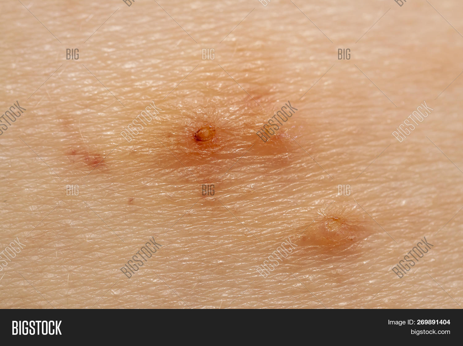 Close Molluscum Image & Photo (Free Trial) | Bigstock