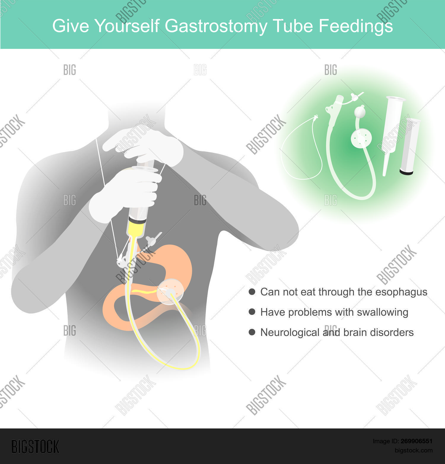 Use Feeding Tube Vector & Photo (Free Trial) | Bigstock