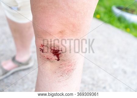 Damage Legs During Image & Photo (Free Trial) | Bigstock
