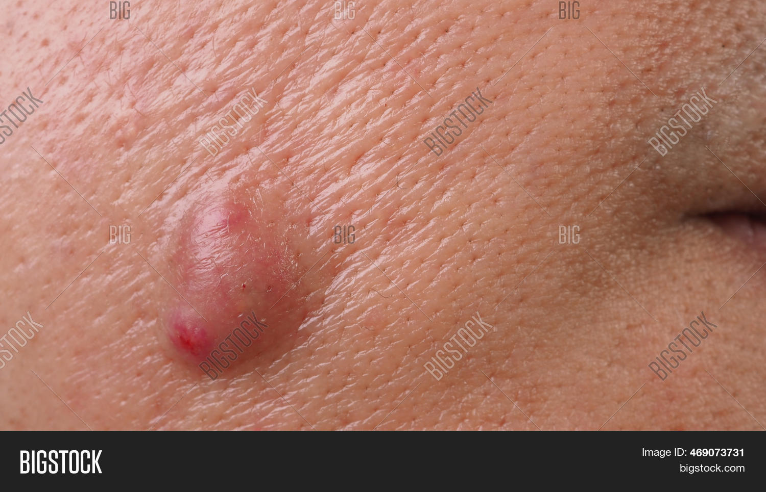 Big Acne Cyst Abscess Image & Photo (Free Trial) | Bigstock