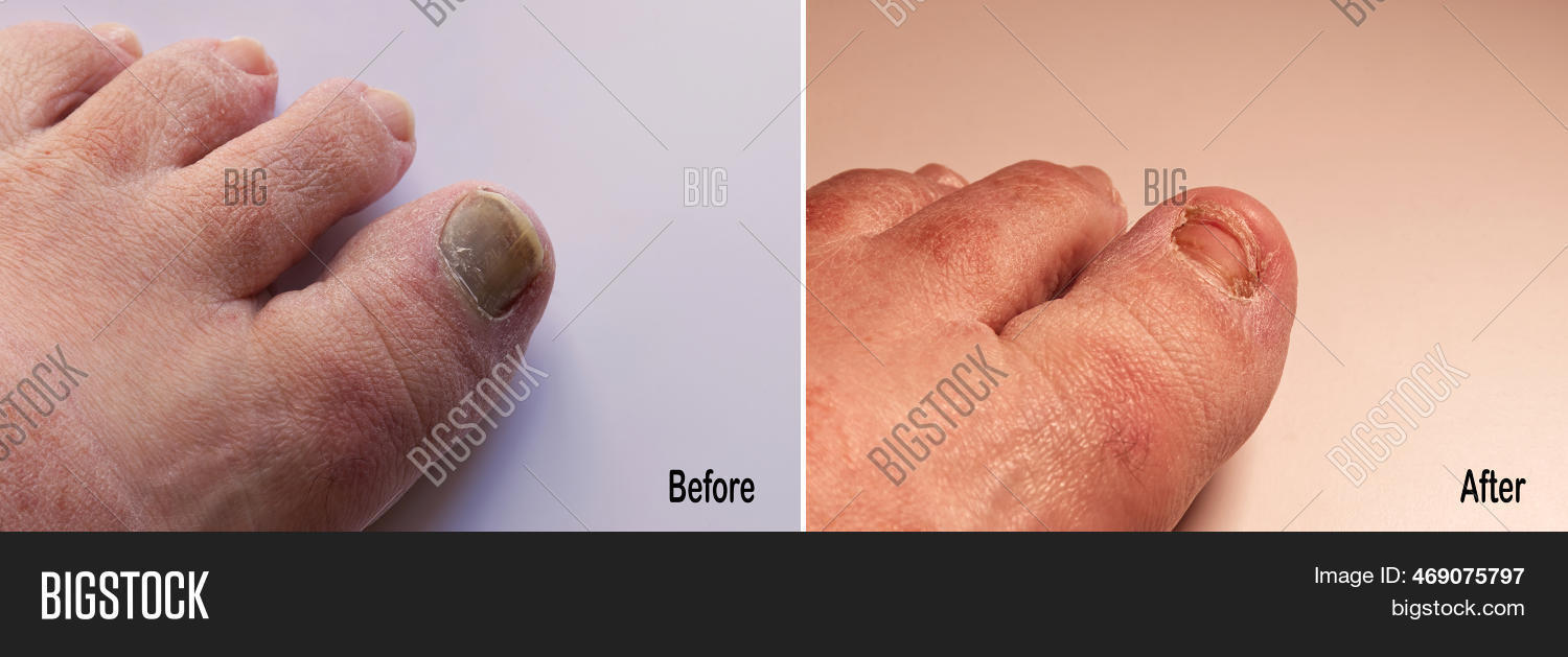 New Healthy Toenail Image & Photo (Free Trial) | Bigstock